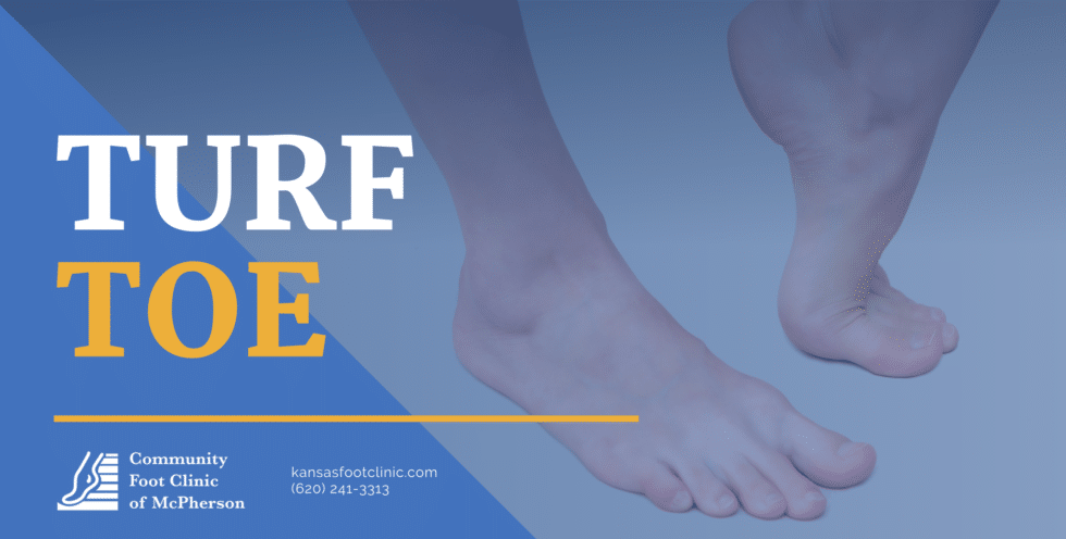 Comprehensive Turf Toe Treatment | Community Foot Clinic of McPherson